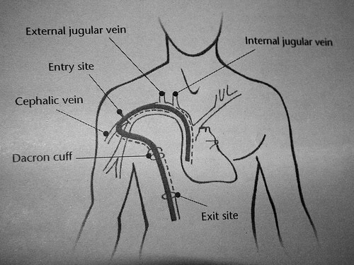 Elijah's Journey: Meet Elijah's Hickman Line