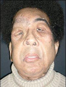 Face transplants: In pictures ~ UNUSUAL THINGs