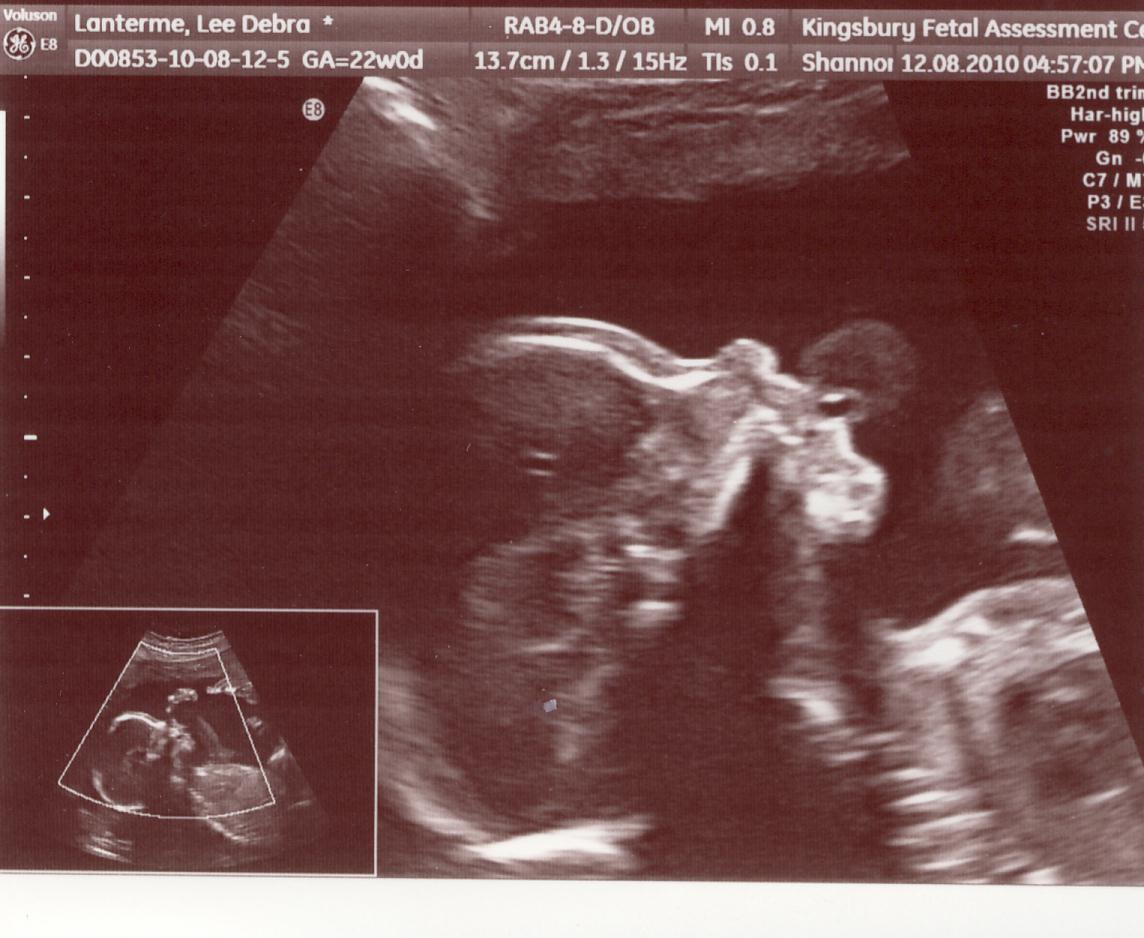 Baby Lanterme: 22 week scan