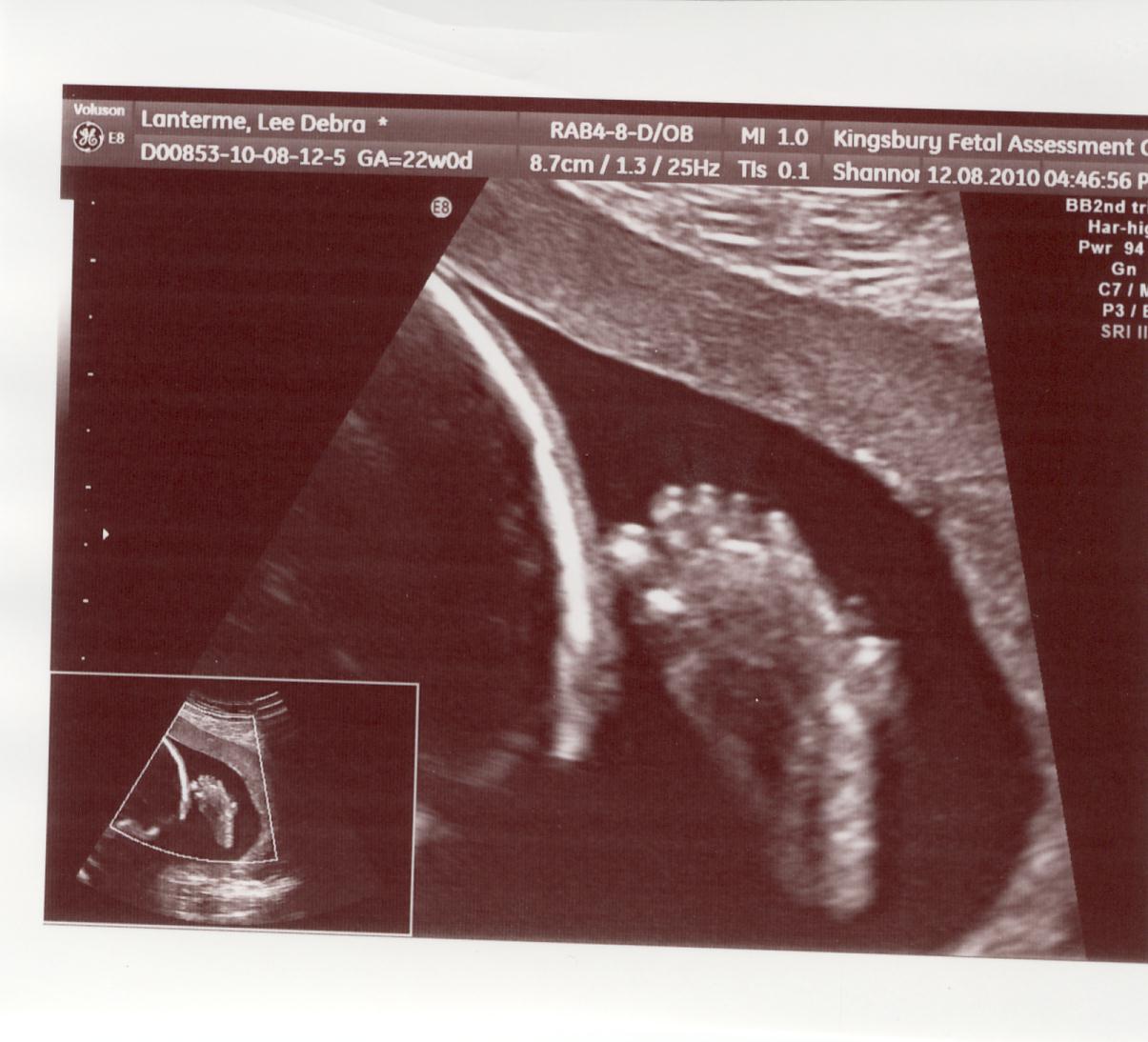 Baby Lanterme: 22 week scan