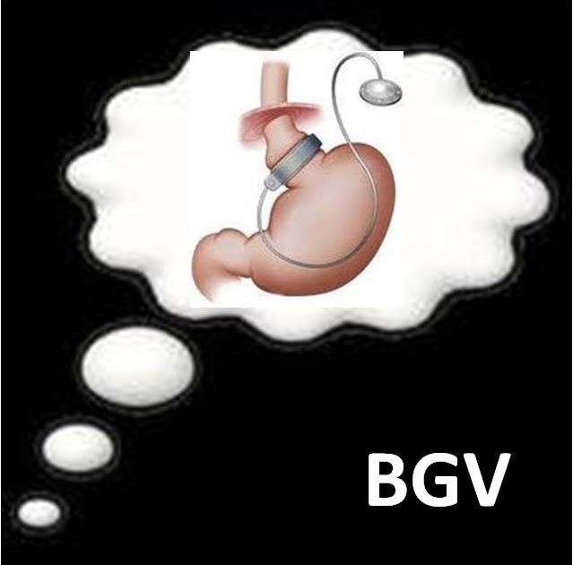 ¿Cómo es el procedimiento de la BGV Aequilibrium? ~ Banda Gástrica ...