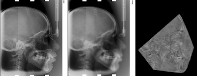 Orthodontic Corner: Automated Digital Tracing of Lateral Cephalograms ...
