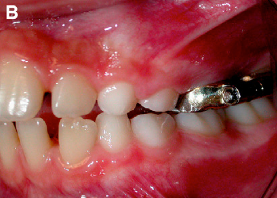 Orthodontic Corner: Non compliance first molar distalization, AmJO May 2010