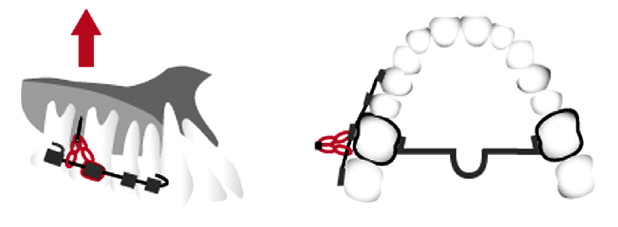 Orthodontic Corner: Mandibular deviation and canted maxillary occlusal ...