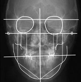 Orthodontic Corner: Mandibular deviation and canted maxillary occlusal ...