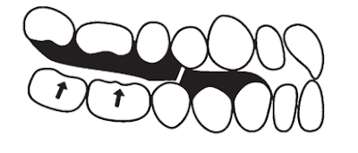 Orthodontic Corner: Design and Management of Twin Blocks