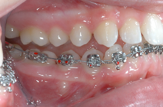 Orthodontic Corner: Design and Management of Twin Blocks