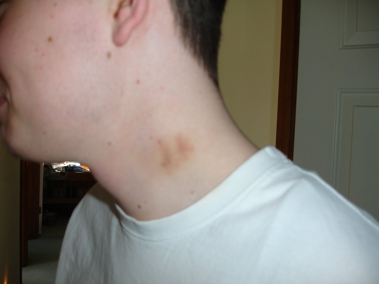 Never Growing Old: A Hickey!!!!