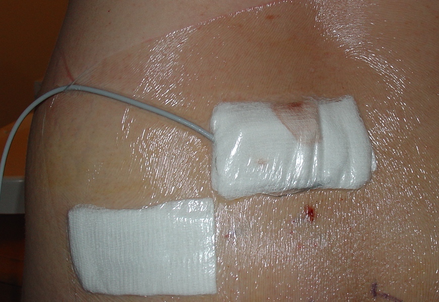 Day 1 after part 1 surgery of InterStim | Random Thoughts