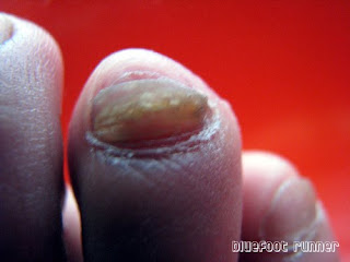 Bluefoot Runner: Dead Toenails from Running: Tips and Advice