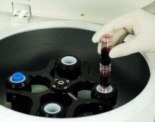 Atasi Kebotakan dengan Darah Anda Sendiri: Pembuatan PRP