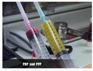 Atasi Kebotakan dengan Darah Anda Sendiri: Pembuatan PRP
