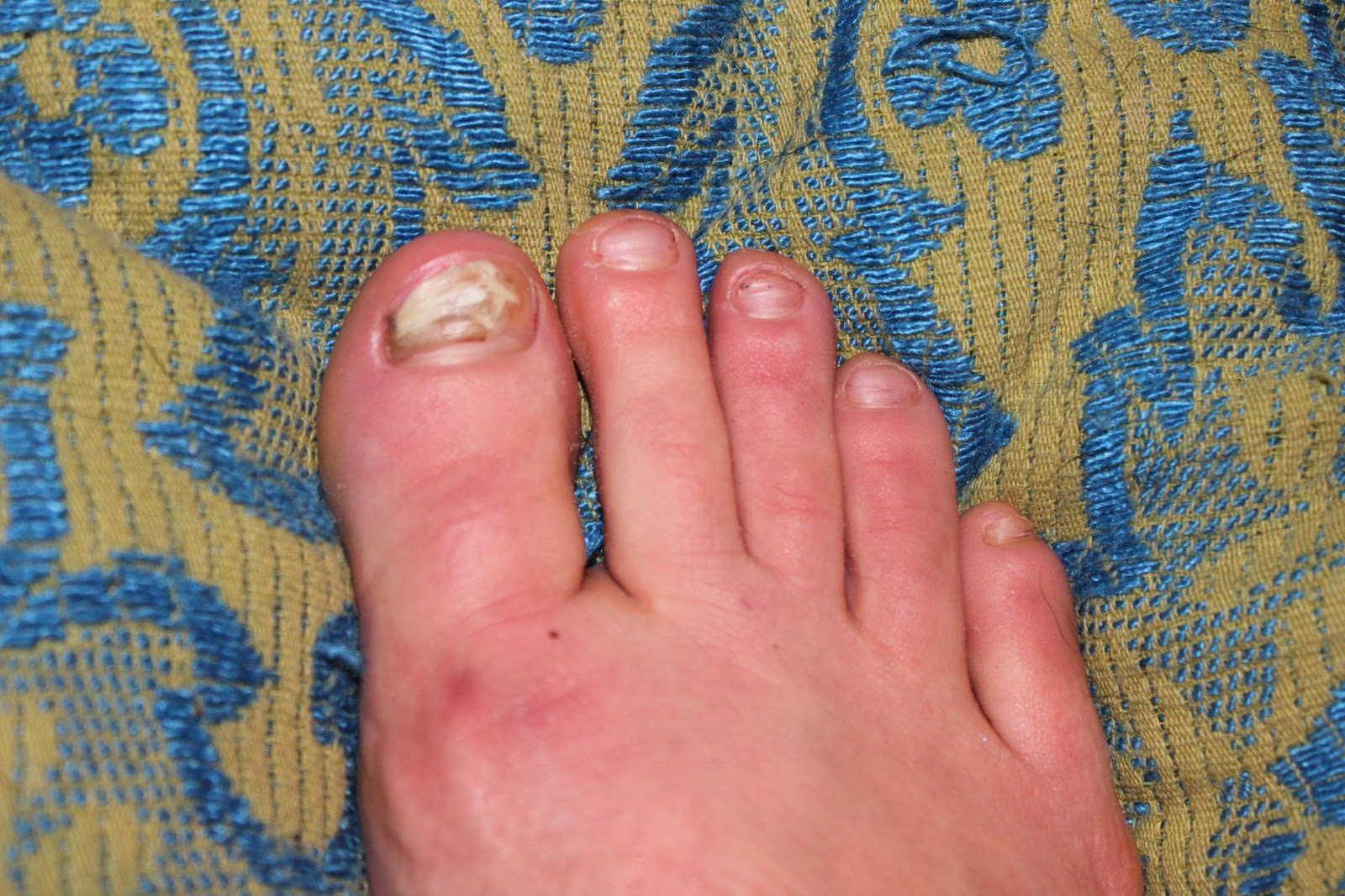 Candice Burt: Yes, I'm losing toenails