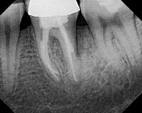 Innovative Endodontics in Ellicott City Maryland: Perforation Repair