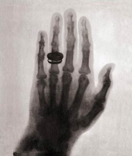 World's First Happened things: World's First X-Ray (1895)