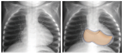 CESMED: SIGNOS RADIOGRAFICOS: Tetralogy of Fallot and Boot-shaped Heart