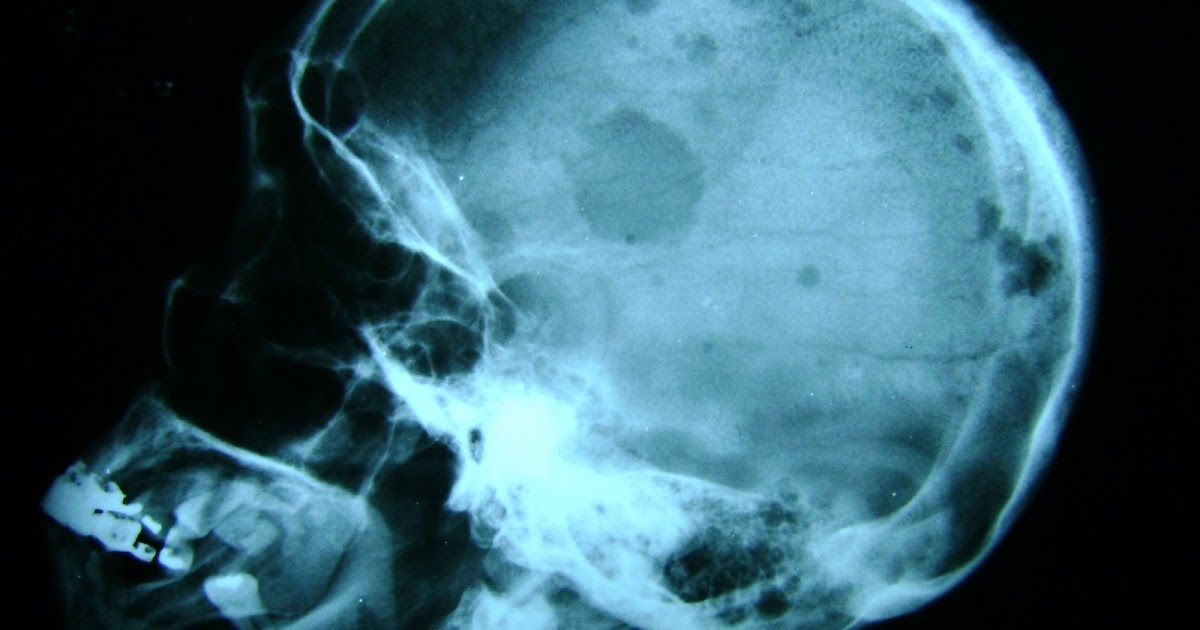 CESMED: Rx lateral de cráneo: Mieloma Múltiple