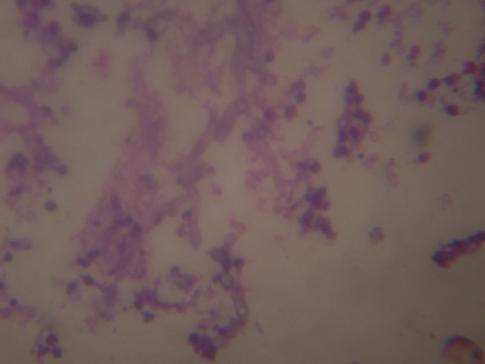 My Pathology: mucormycosis