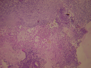 My Pathology: amoebiasis