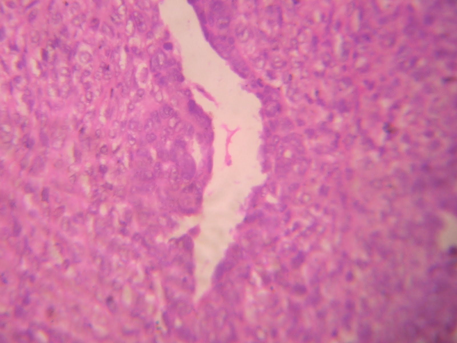 My Pathology: malignant mixed mullerian tumour