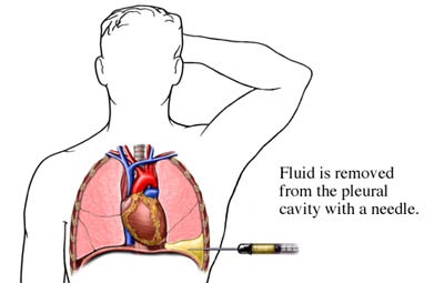 Angelite Nurses: Thoracentesis