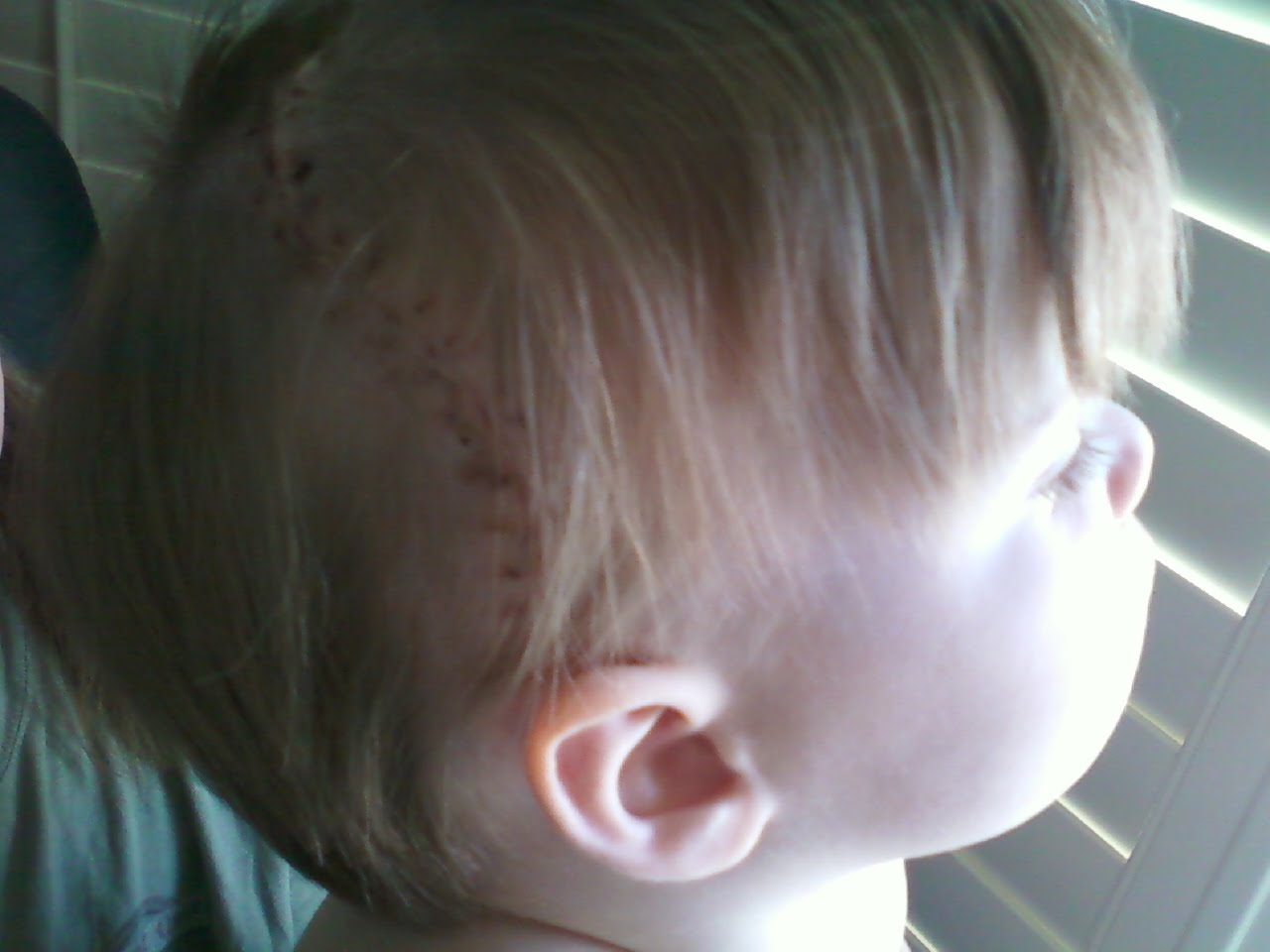 Keegan's Craniosynostosis: Staple Removal