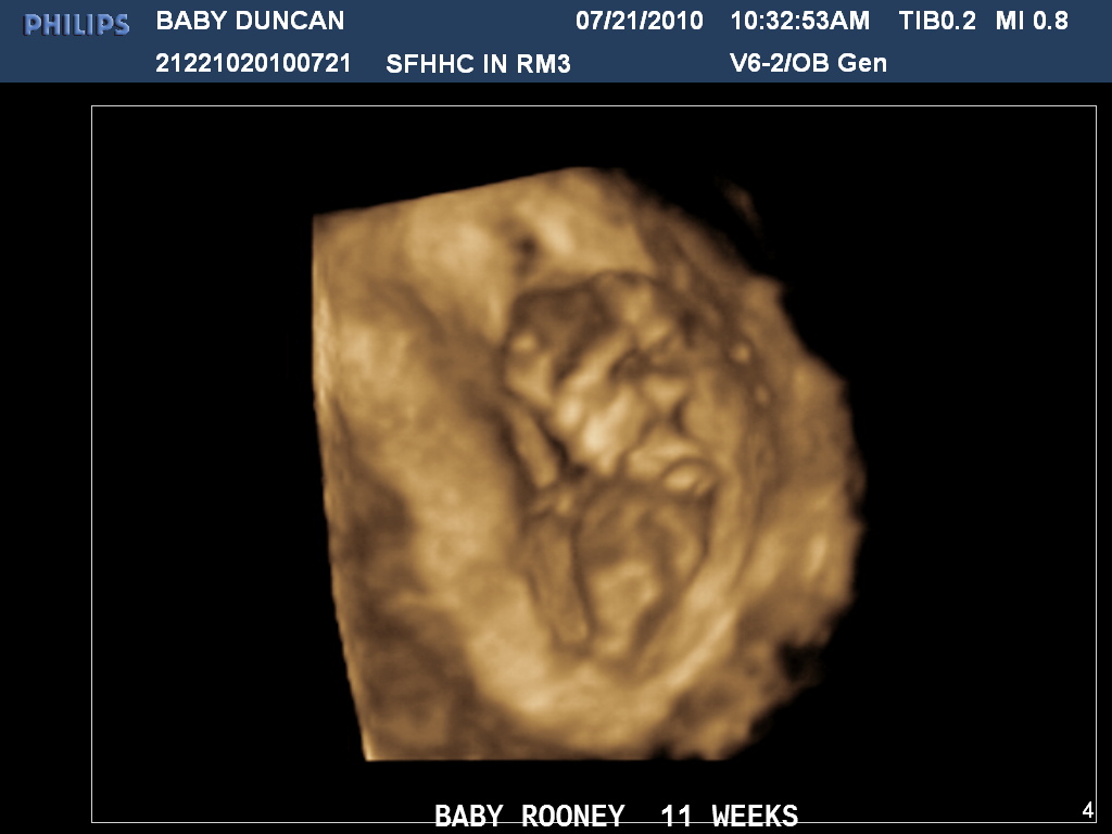 Rooney Adventures in Pregnancy: 11 weeks ultrasounds and 3ds