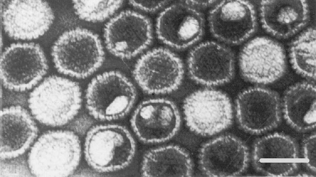 Varicella Zoster Virus Symptoms