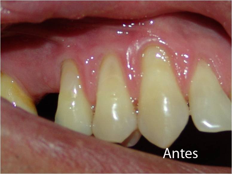 Periodontista Luciane Rossatto Silveira: Enxerto Conjuntivo