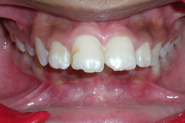 Smile makeovers - Different problems, Different solutions: Dental ...