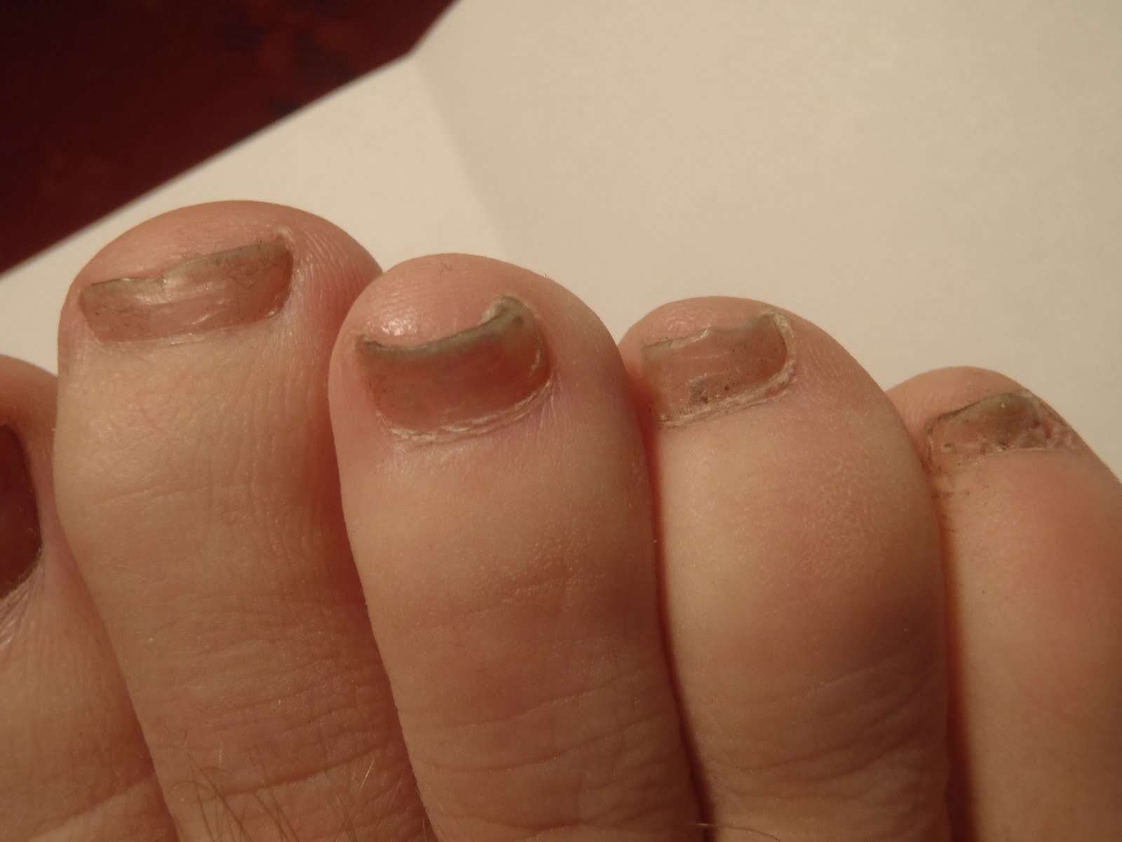 The nail fungus blog: Toenails