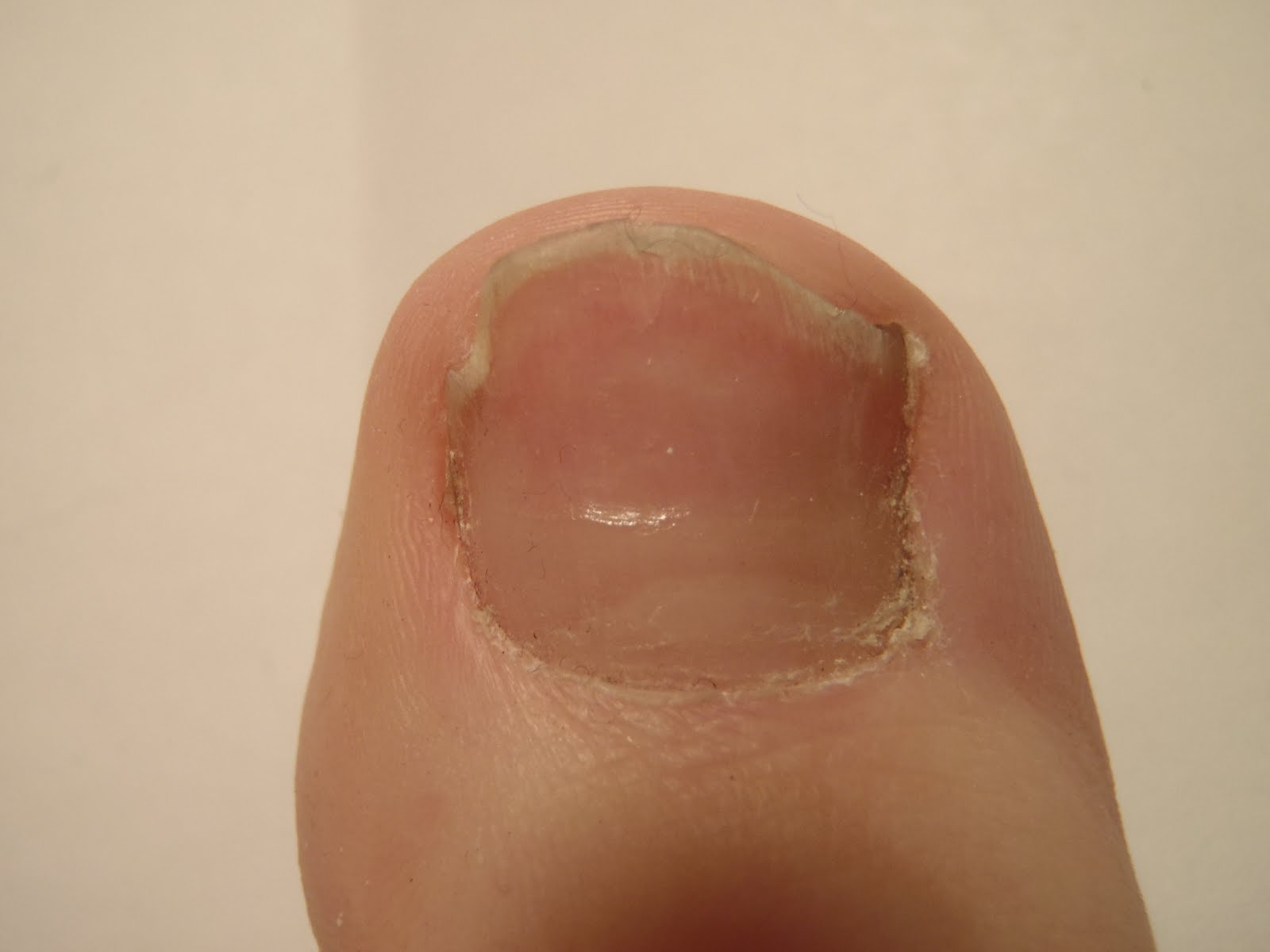The nail fungus blog: Toenails