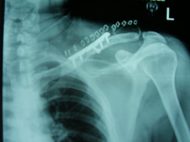 Dr Anurag Awasthi's Orthopedic Blog : Collar Bone fracture : Is ...