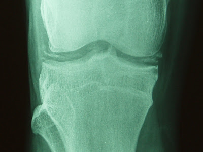 casos clinicos en atencion primaria: condrocalcinosis