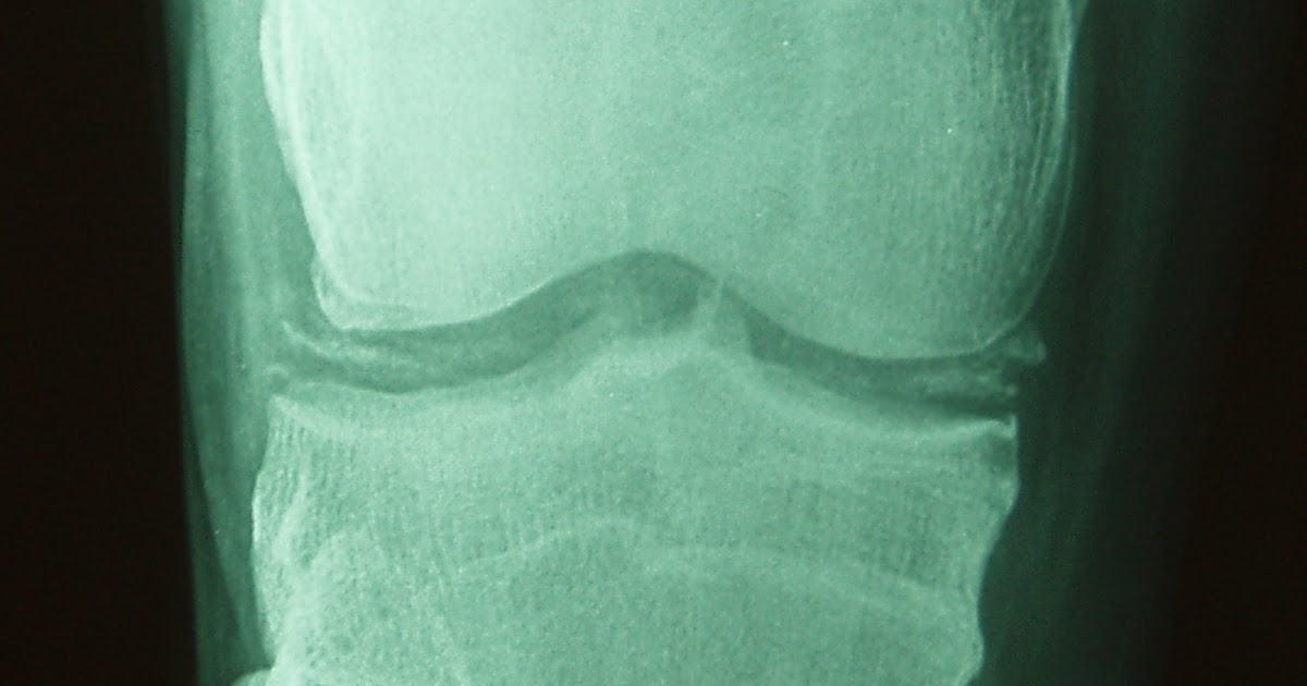 casos clinicos en atencion primaria: condrocalcinosis