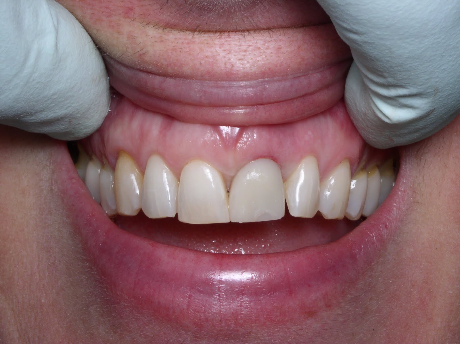 Periodontal - Implant Cases by Dr. Thomas Kang: Anterior implant placement