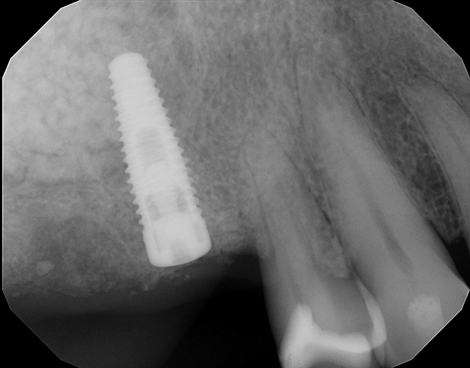 Periodontal - Implant Cases by Dr. Thomas Kang: Sinus Elevation with ...