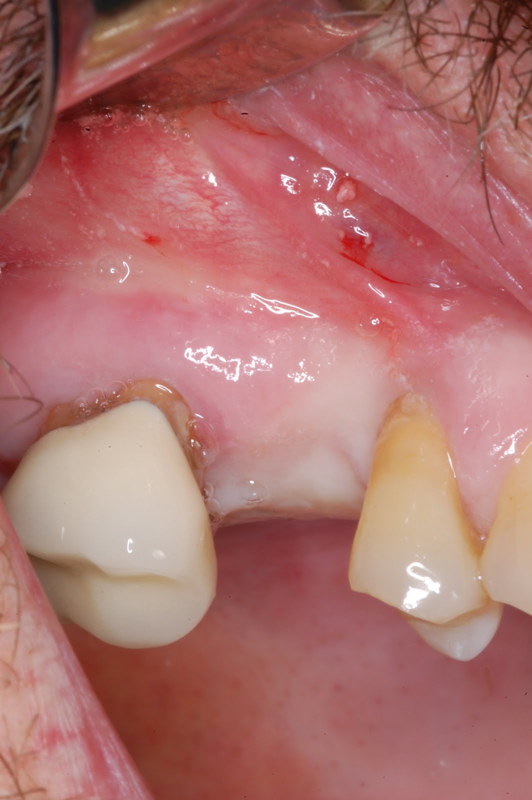 Periodontal - Implant Cases by Dr. Thomas Kang: Sinus Elevation with ...