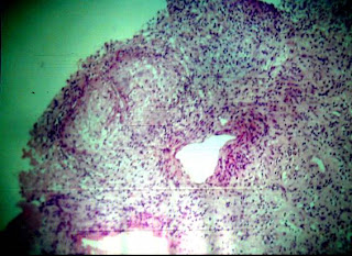 biomedicpatology: NECROSE CASEOSA