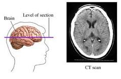 CT SCAN| Computed Tomography Scan|Cat Scan: CT Scan Brain