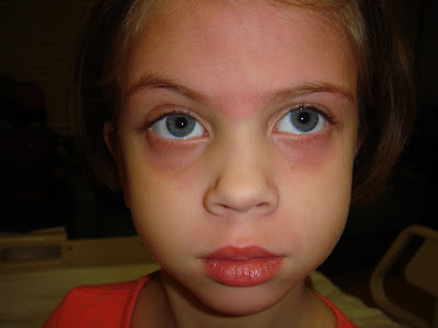 Lex blog: red man syndrome