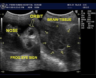 Radiology Teaching Files: Neural tube defects