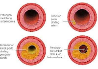 CORONARY ARTERY DISEASE: Penyakit Arteri Koronari (CAD)