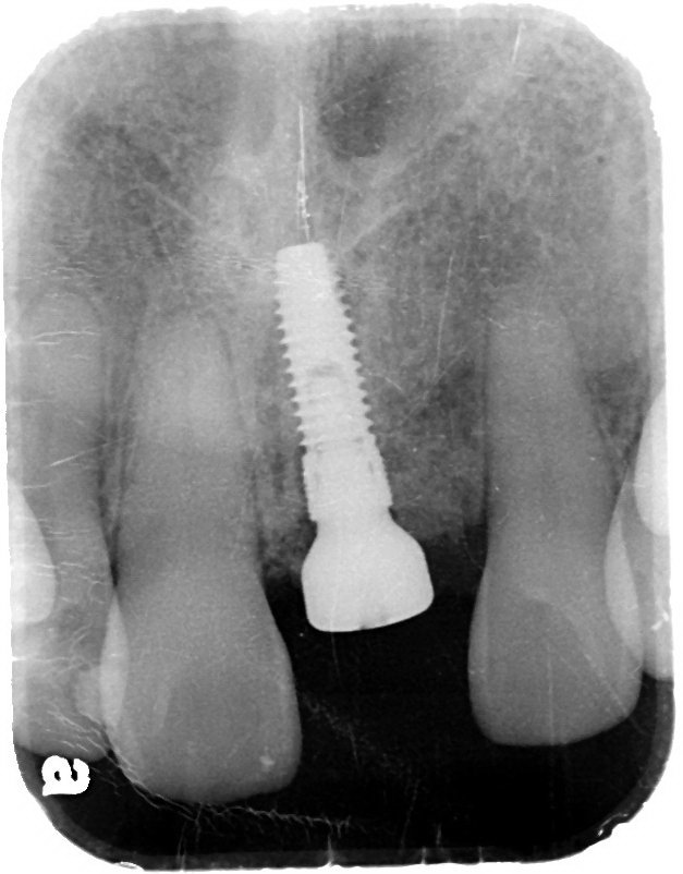 Dental Implant Narrow Ridge at William Swoope blog