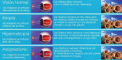 Dr. Rogelio Villarreal Villarreal: LASIK (Cirugía Laser de Ojos)