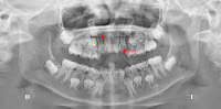 DIAGNOSTICOS POR IMAGENES: DIENTES SUPERNUMERARIOS (Radiografía ...