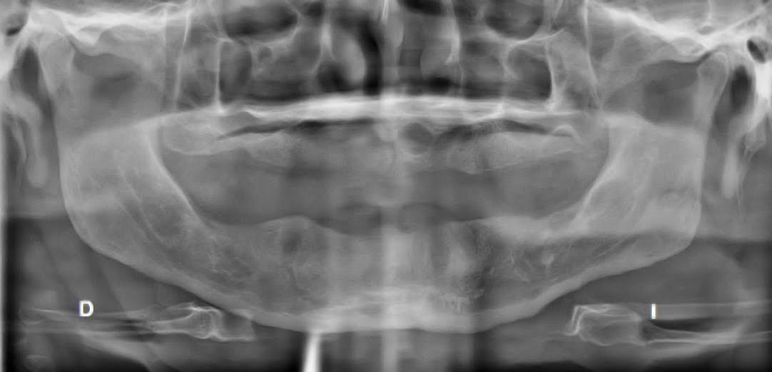 DIAGNOSTICOS POR IMAGENES: QUISTE RESIDUAL (Radiografía Panorámica Digital)