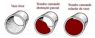 Patologia: Embolia Pulmonar