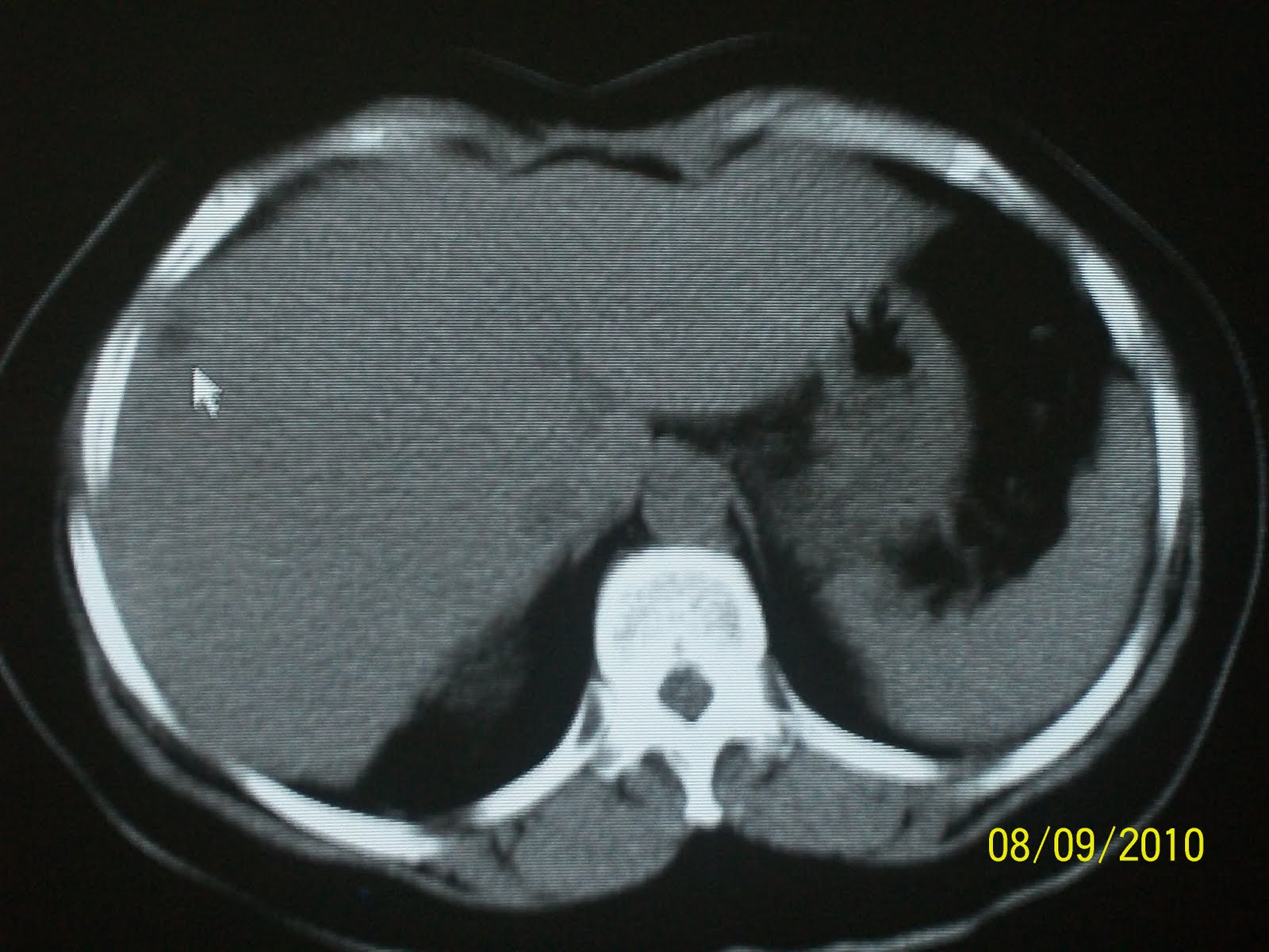 www.tecnicasradiologica2010.blogspot.com: Cancer de Higado: Hepatocarcinoma