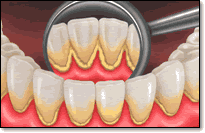 los dientes sanos: CALCULO DENTAL